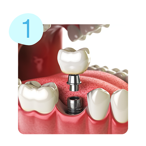 Dental Implants | westmountdentist.com